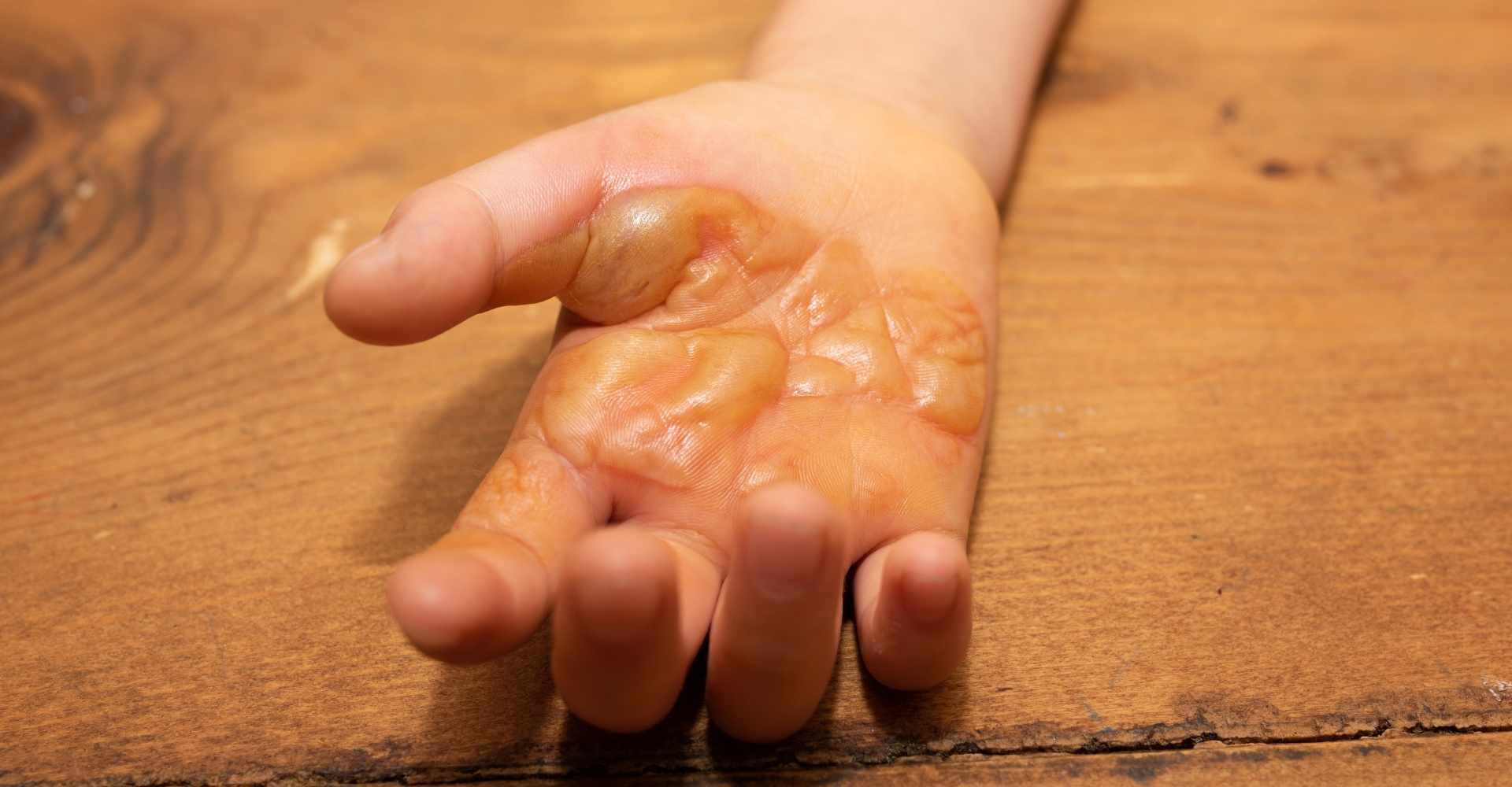 Burns From Hot Foods And Liquids: Know The Risks